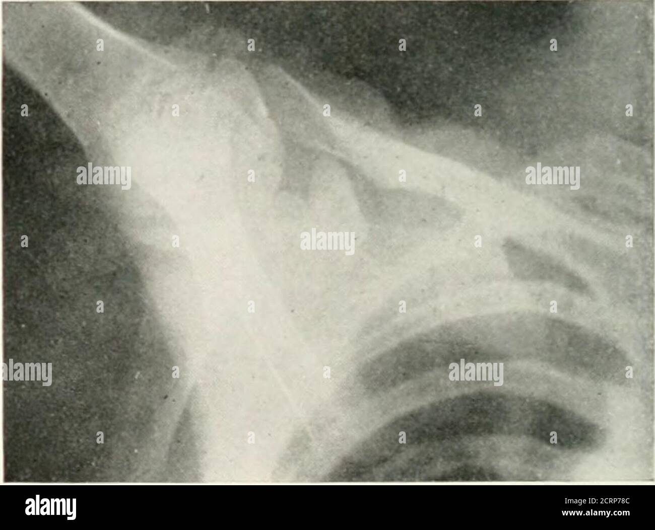. Radiography, x-ray therapeutics and radium therapy . PLATE VI.—Normal ...
