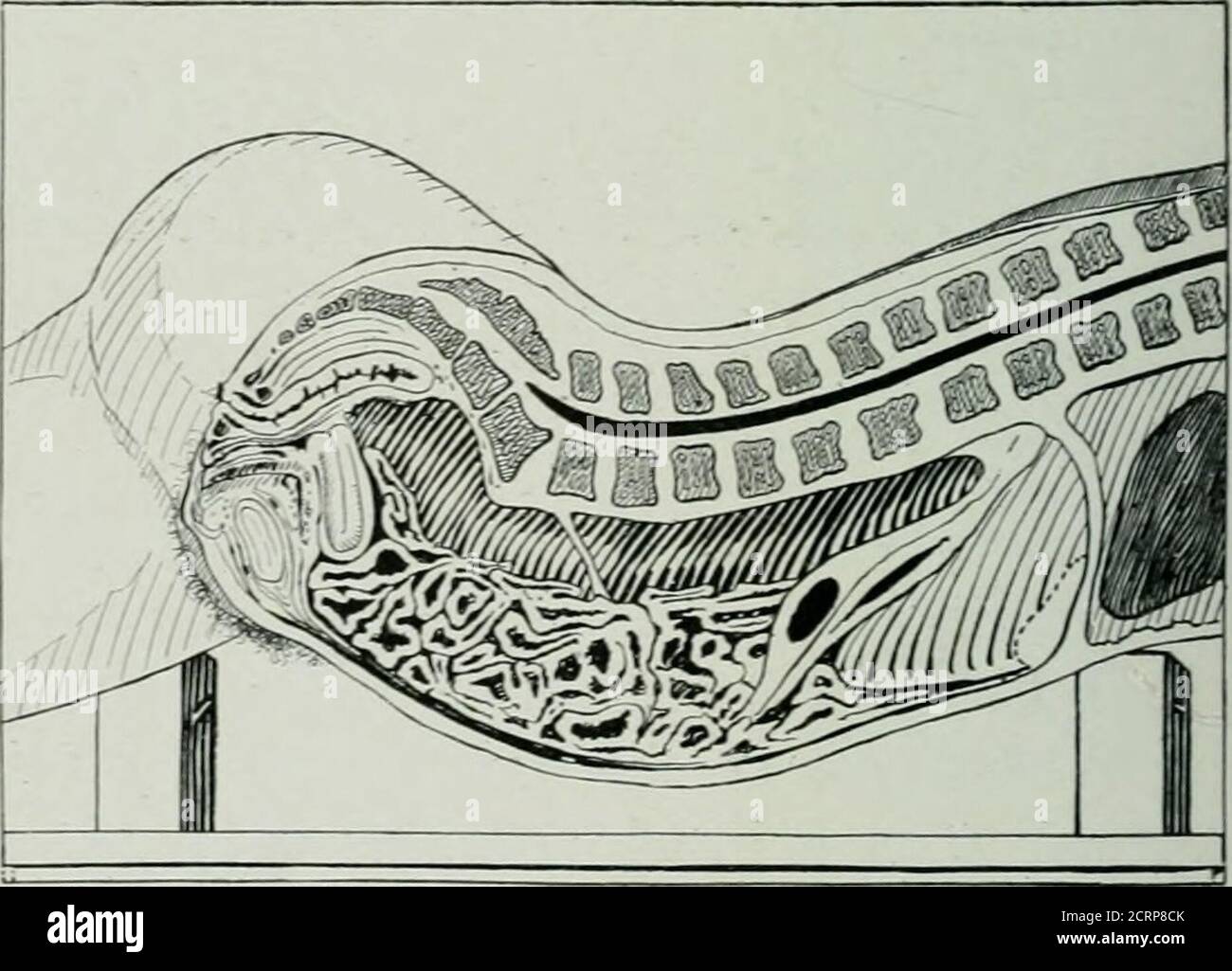 Psoas abscess hi-res stock photography and images - Alamy