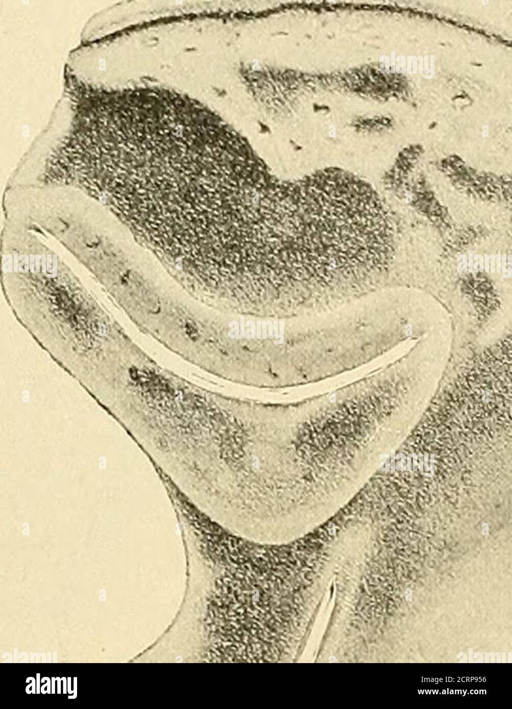 Symphysiotomy hi-res stock photography and images - Alamy