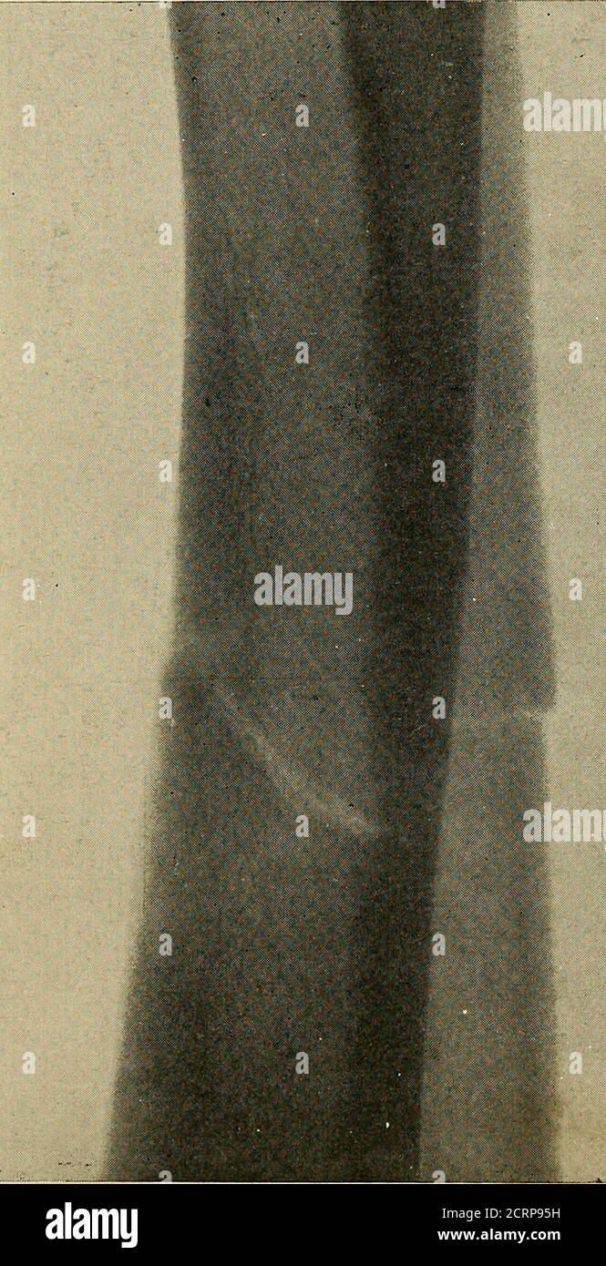 Thirty pounds of bone hi-res stock photography and images - Alamy