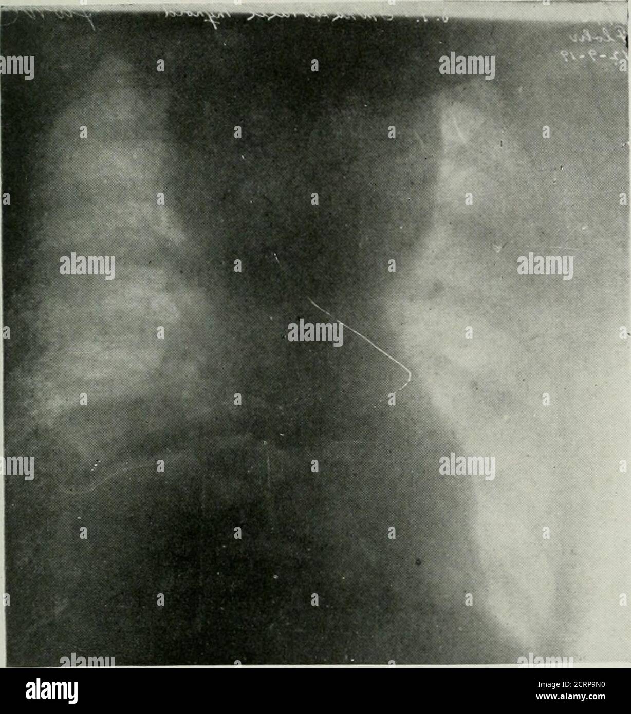 Benign lung hi-res stock photography and images - Alamy