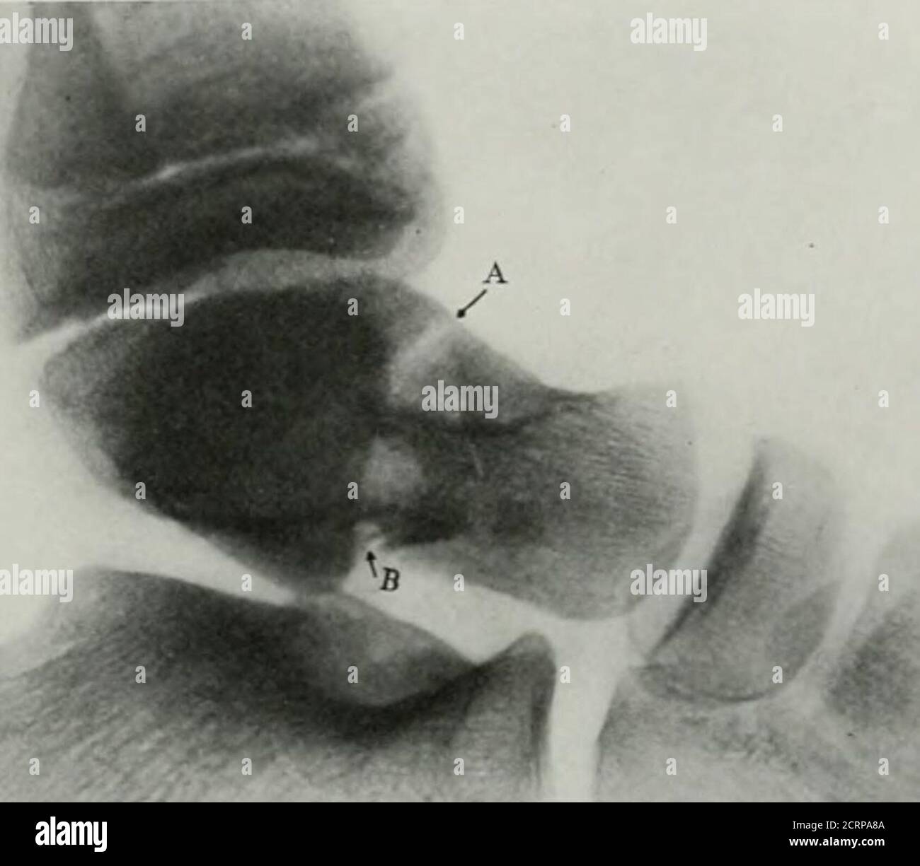 Formation of an abscess hi-res stock photography and images - Alamy