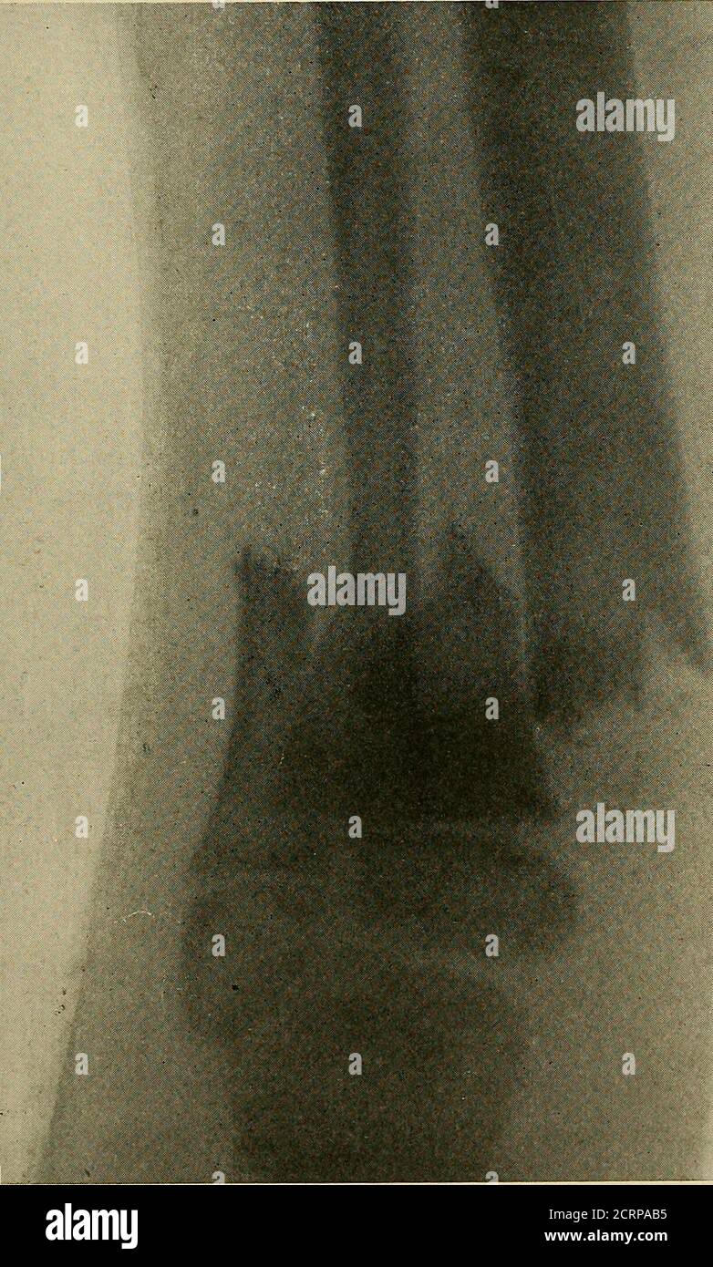 Lower leg fracture x ray hi-res stock photography and images - Alamy