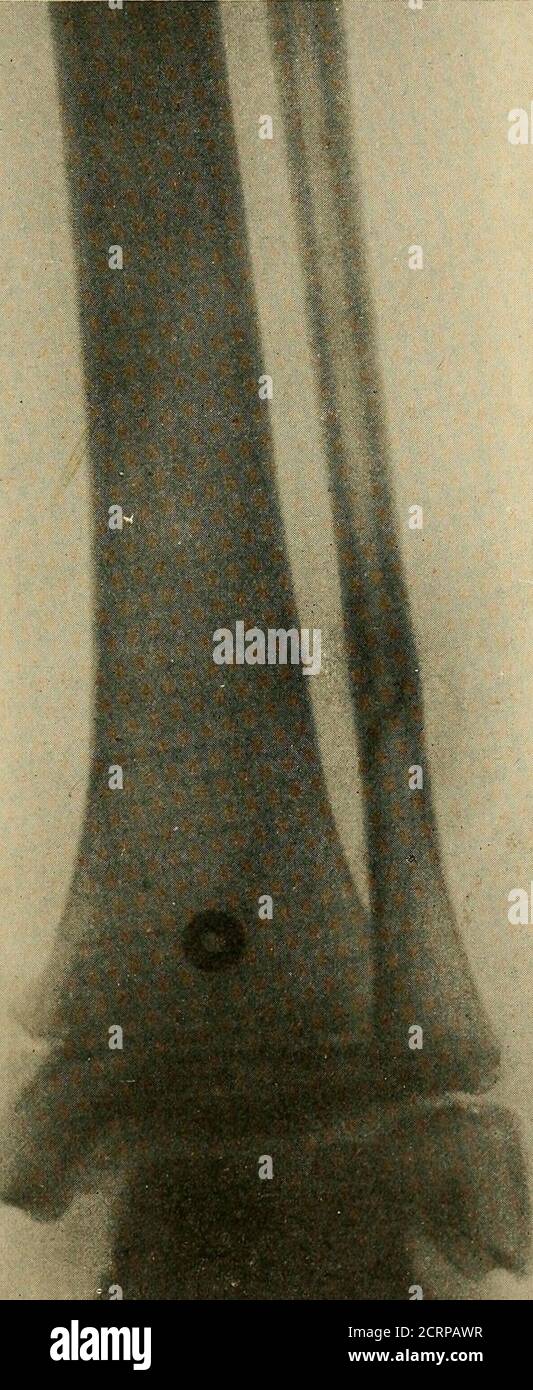 . The Roentgen rays in medicine and surgery as an aid in diagnosis and ...