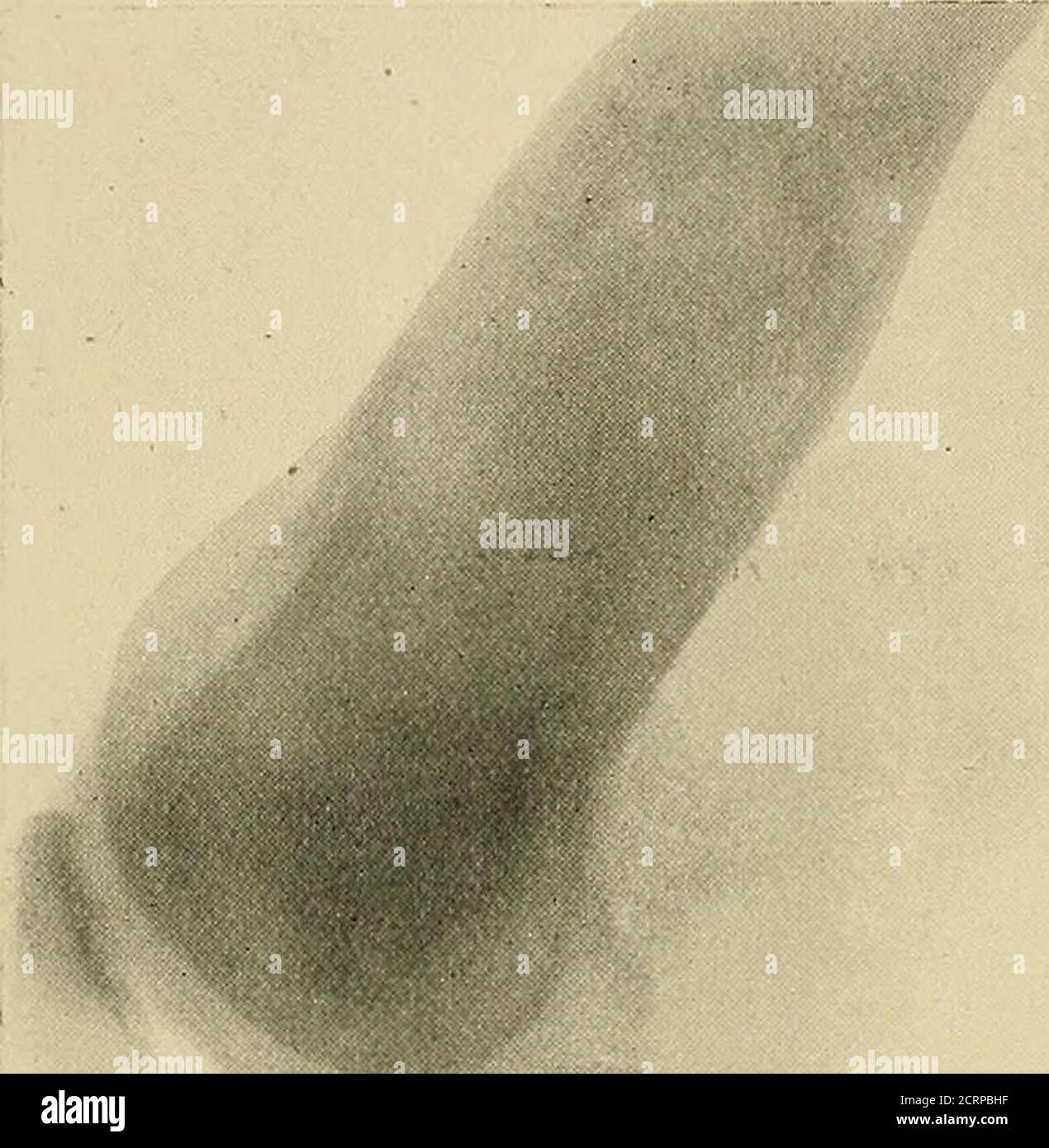 . The Röntgen rays in medical work . Pig. 141.—Anchylosis of Elbow and ...