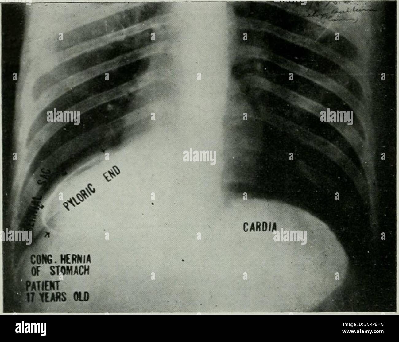 Eventration hi-res stock photography and images - Alamy