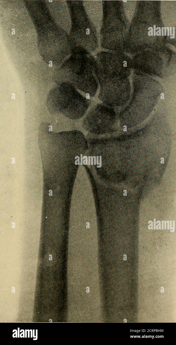 . The Roentgen rays in medicine and surgery as an aid in diagnosis and ...