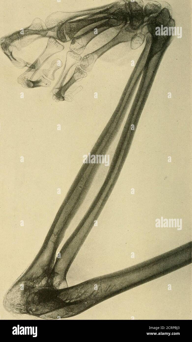 Thickened femur hi-res stock photography and images - Alamy