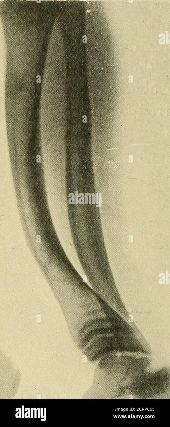 . The Röntgen rays in medical work . Fig. 139.—Rachitic Defoemity in ...