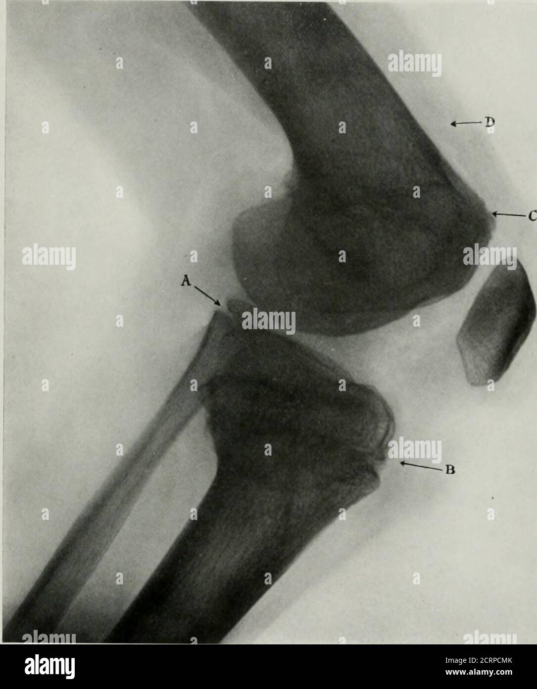 Cellulitis arm hi-res stock photography and images - Alamy