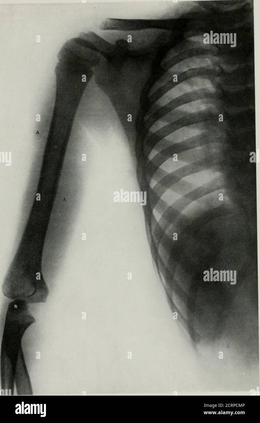 Cellulitis arm hi-res stock photography and images - Alamy