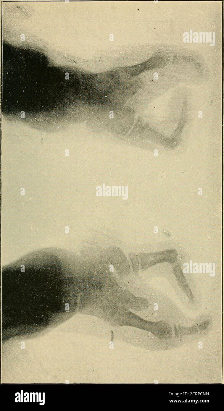 Two toed feet hi-res stock photography and images - Alamy