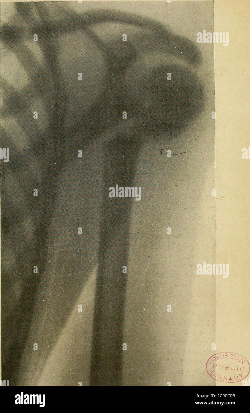 . The Roentgen rays in medicine and surgery as an aid in diagnosis and ...