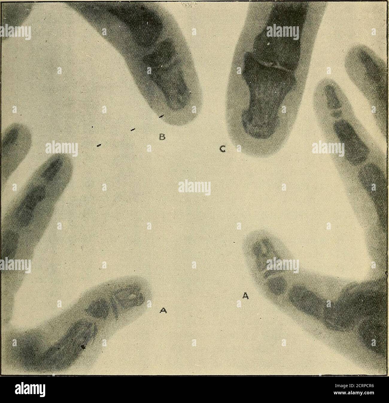 . The Röntgen rays in medical work . Fig. 127.—Mr. Reevess Case of ...