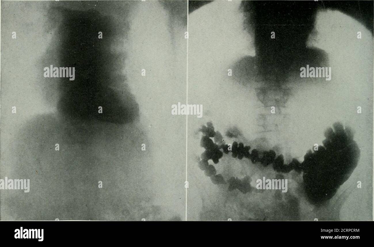 Barium meal hi-res stock photography and images - Alamy