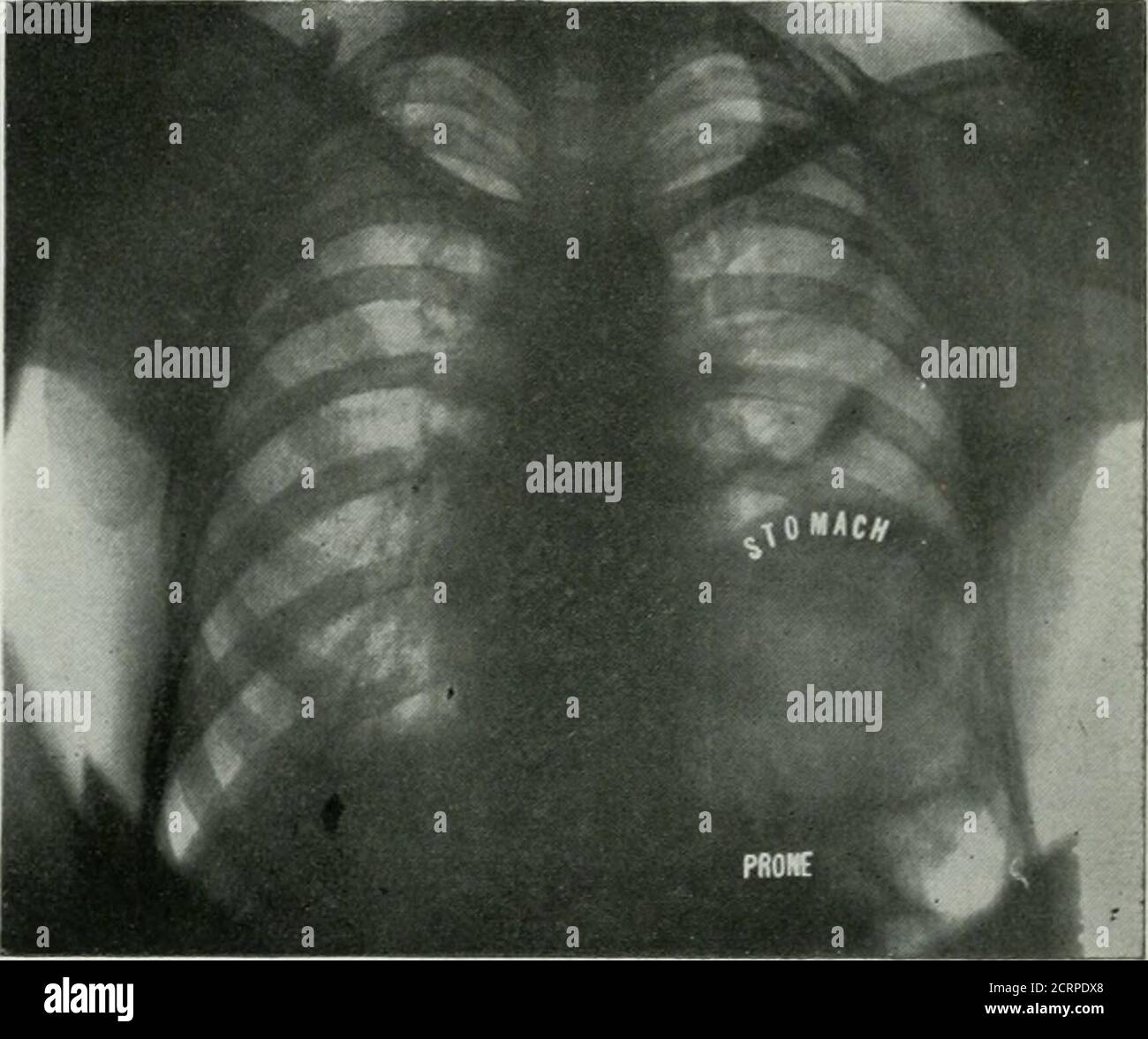 Axillary region hi-res stock photography and images - Alamy