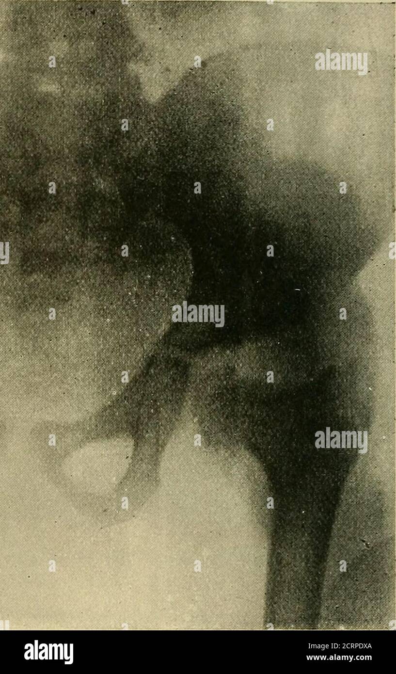 Congenital dislocation of the hip hi-res stock photography and images ...