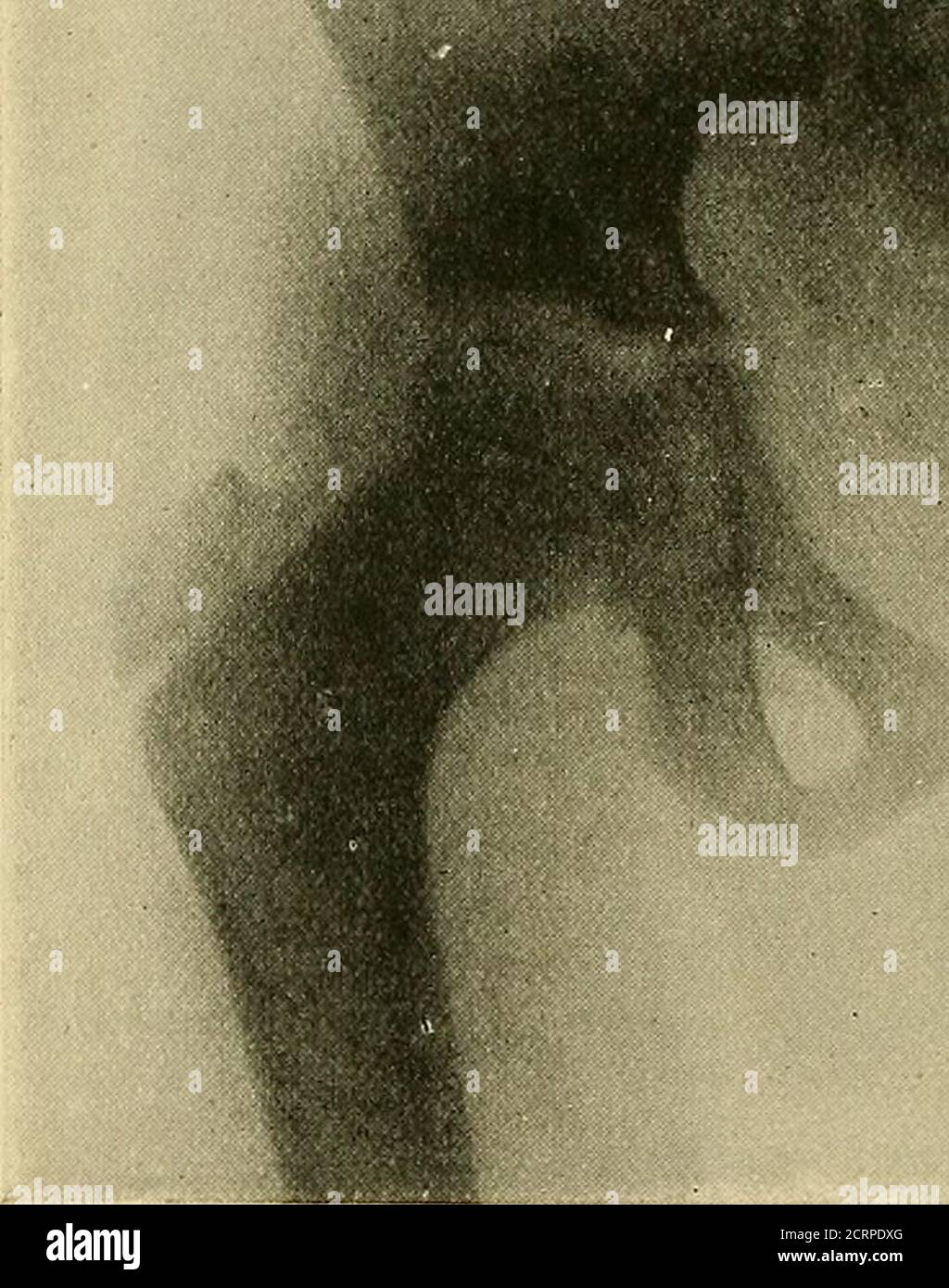 Congenital dislocation of the hip hi-res stock photography and images ...