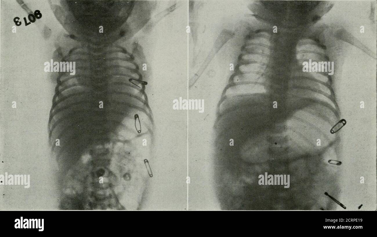 Birth asphyxia hi-res stock photography and images - Alamy