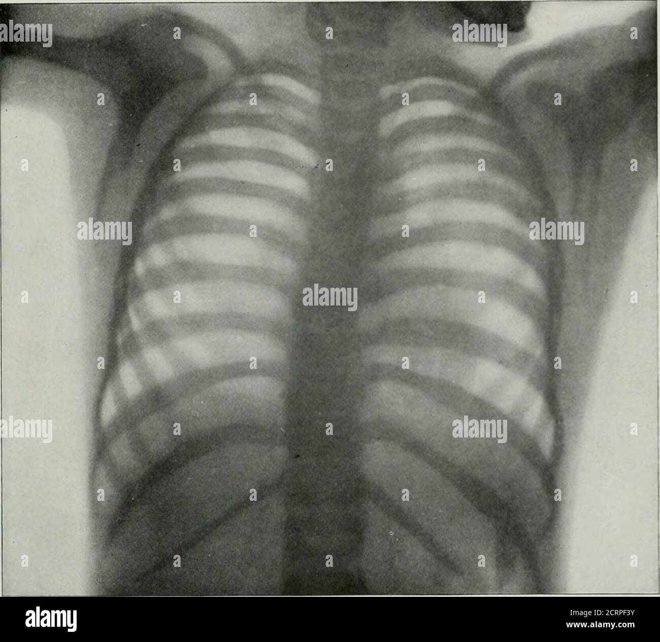 Boy thorax anatomy hi-res stock photography and images - Alamy