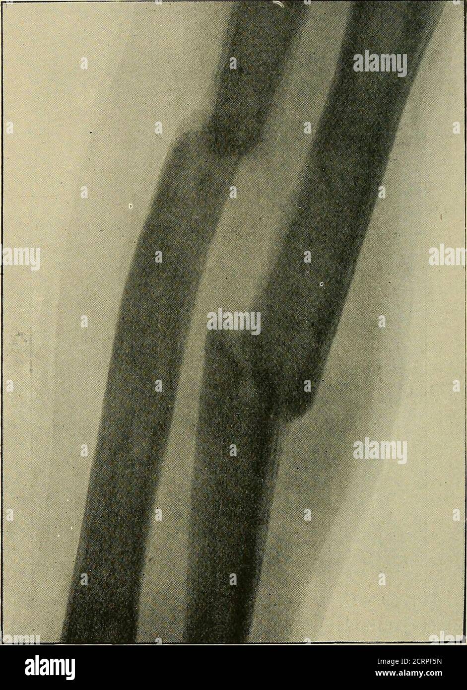 Styloid process of ulna hi-res stock photography and images - Alamy