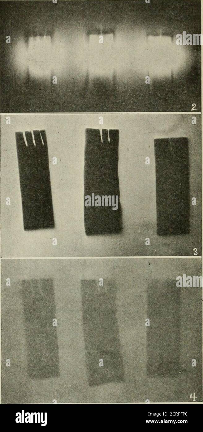 Gamma radiation therapy hi-res stock photography and images - Alamy