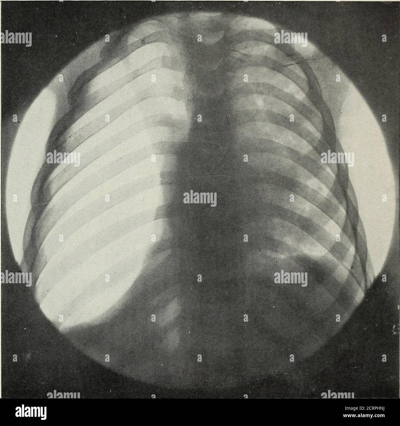 . American quarterly of roentgenology . CARCINOMA OF CLAVICLE AND ...