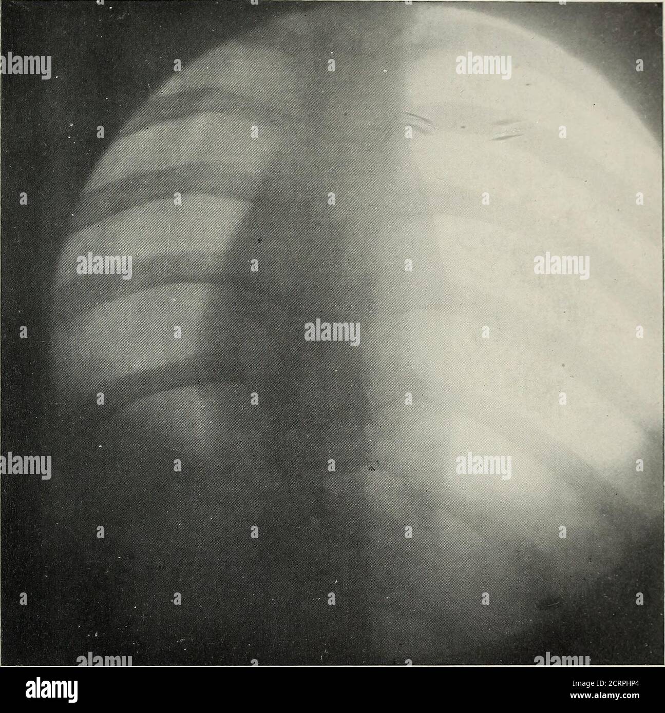 Pneumothorax collapsed lung hi-res stock photography and images - Alamy