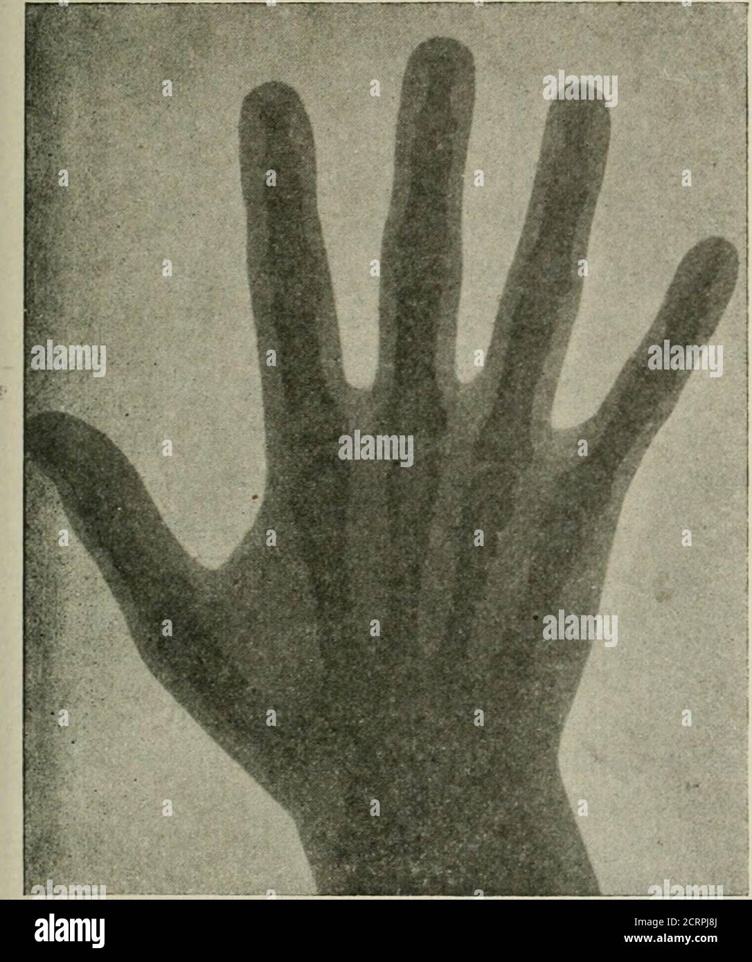 Gamma radiation therapy hi-res stock photography and images - Alamy