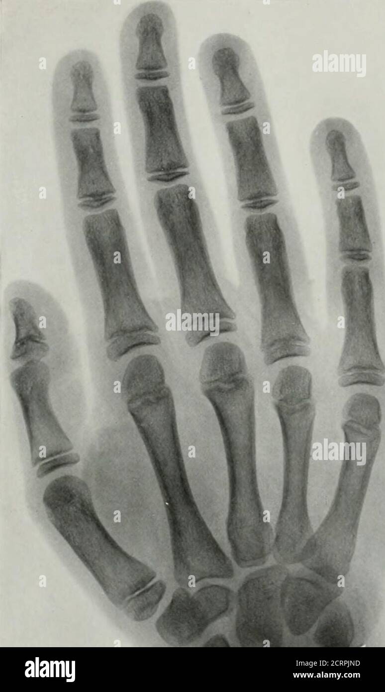 Pisiform Bone High Resolution Stock Photography and Images - Alamy