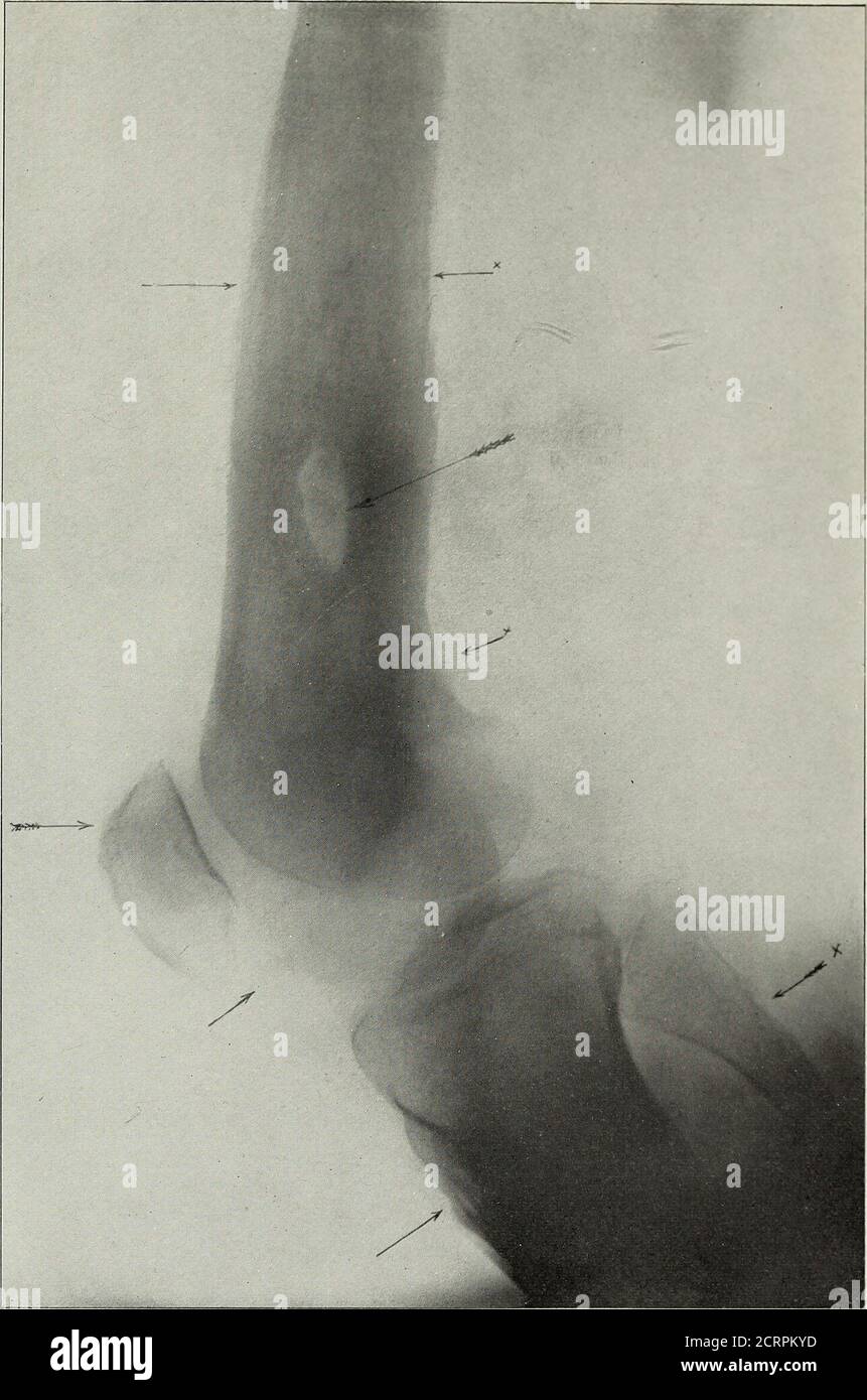 . American quarterly of roentgenology . rcoma corpuscles. OSTEOMA ...