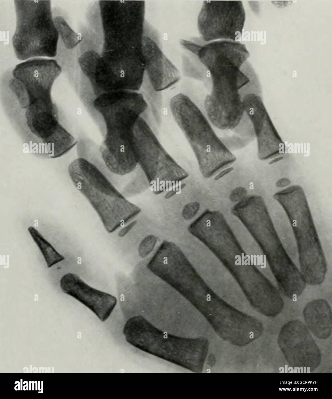 Proximal third of radius hi-res stock photography and images - Alamy