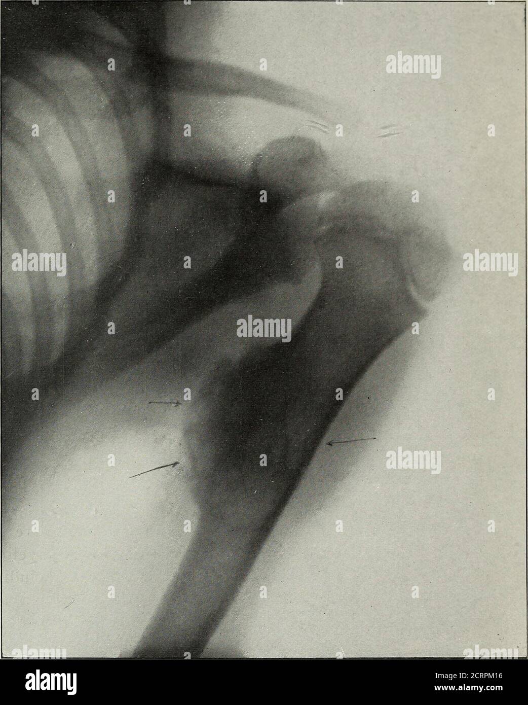 Cretinism High Resolution Stock Photography and Images - Alamy