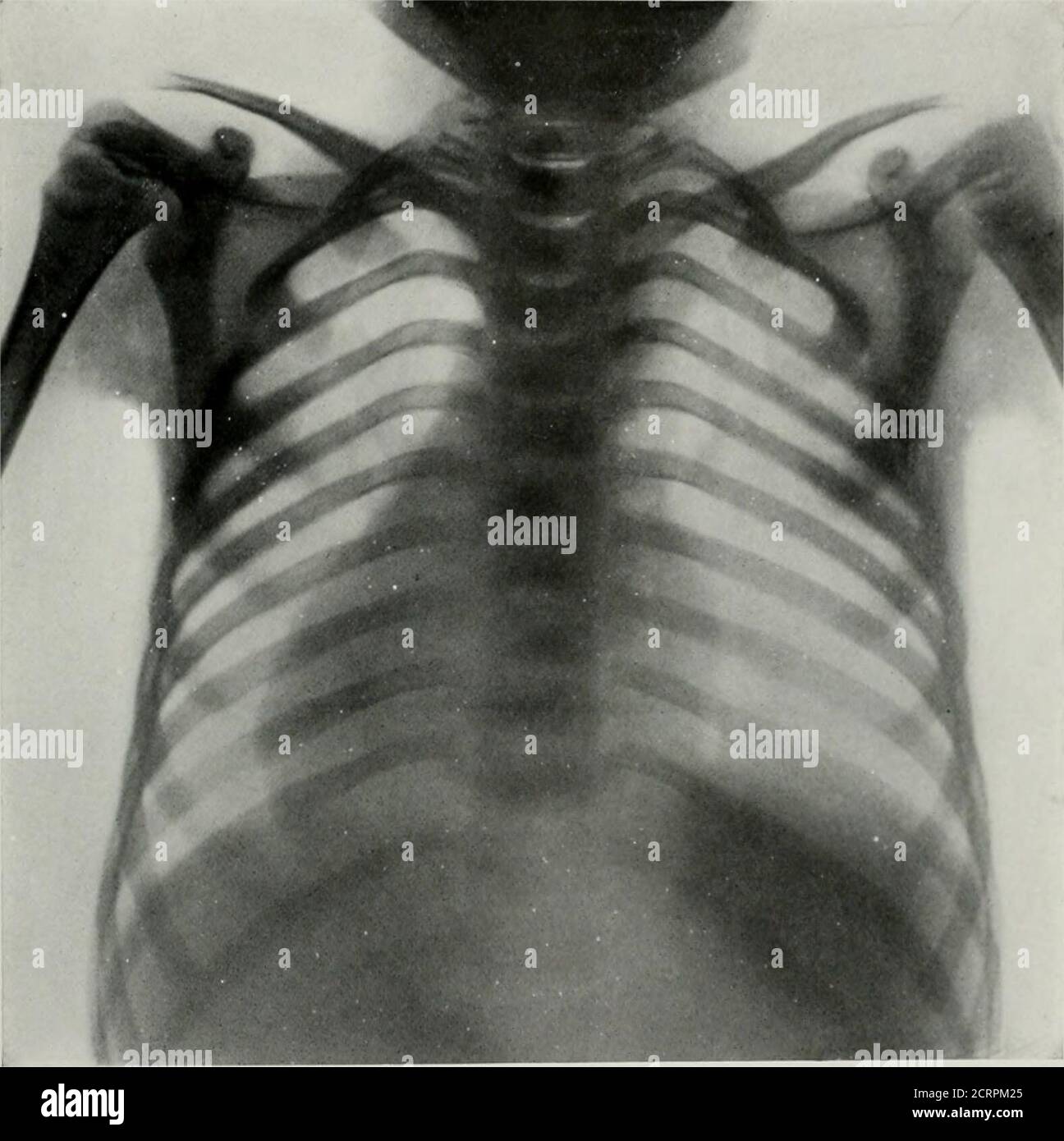 Boy thorax anatomy hi-res stock photography and images - Alamy