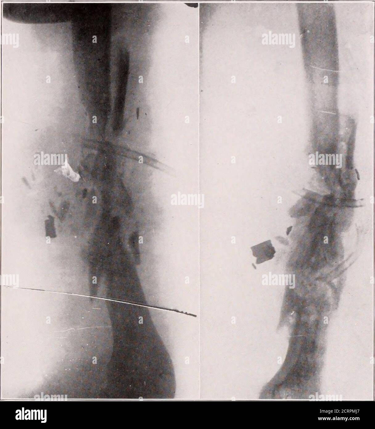 . Journal of roentgenology . detached and par-tially loosened fragments ...