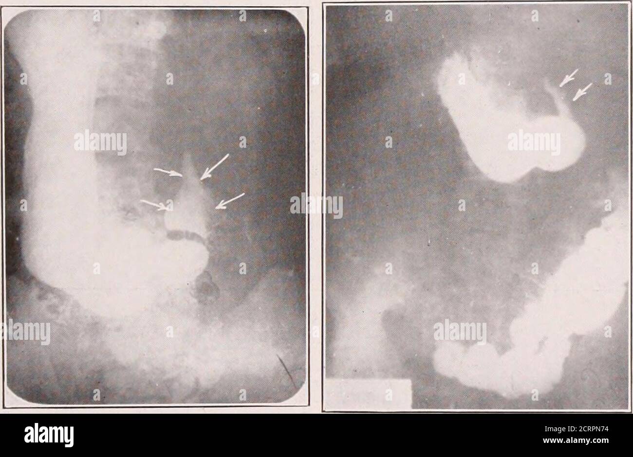 Hepatoduodenal ligament hi-res stock photography and images - Alamy