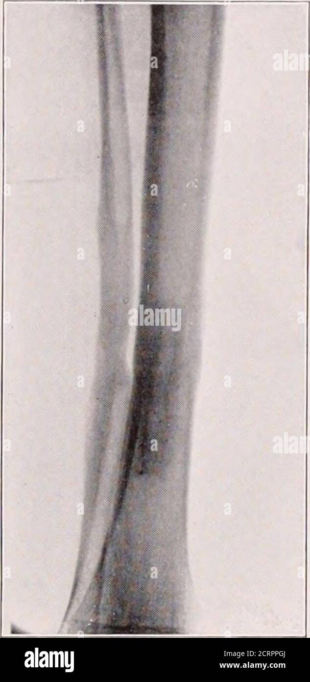 Fibula plates hi-res stock photography and images - Alamy