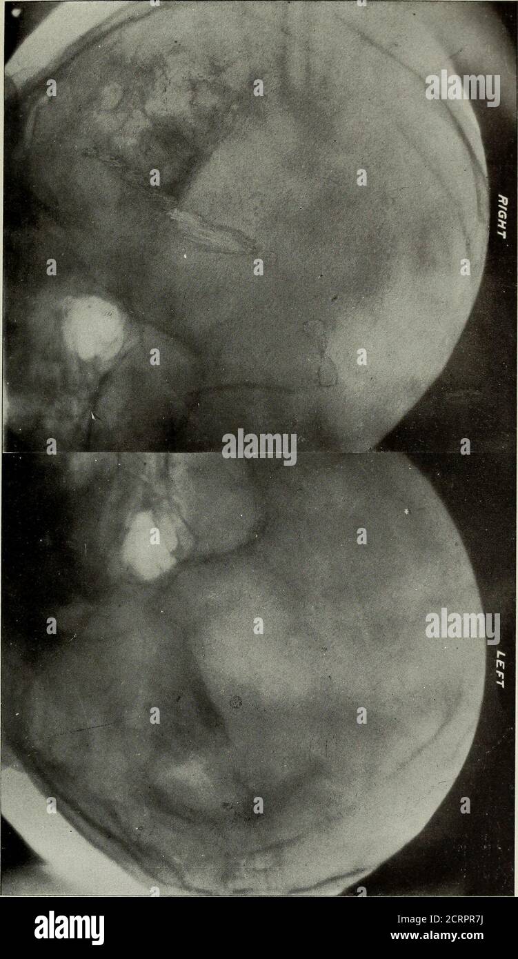Mastoid cases hi-res stock photography and images - Alamy