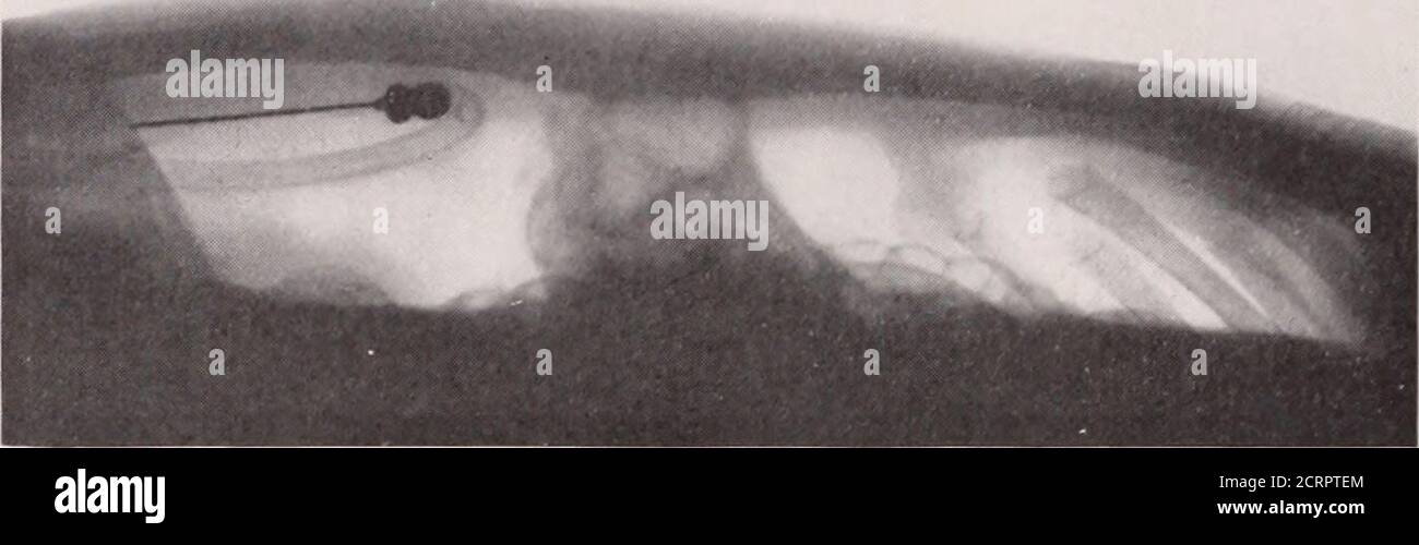 Abdominal Adhesions High Resolution Stock Photography and Images - Alamy