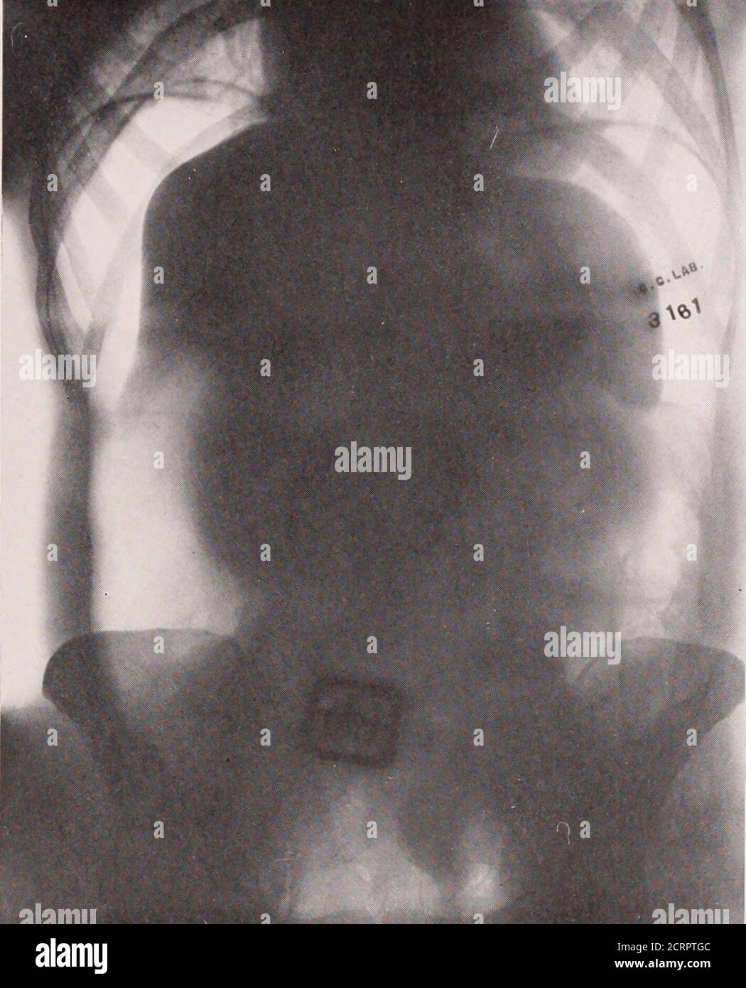 Posterior spleen hi-res stock photography and images - Alamy