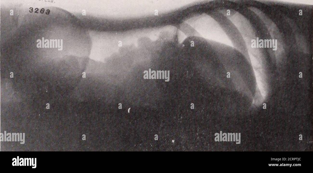 . Journal of roentgenology . No. 3278. ILLUSTRATION IS AN ANTERO ...