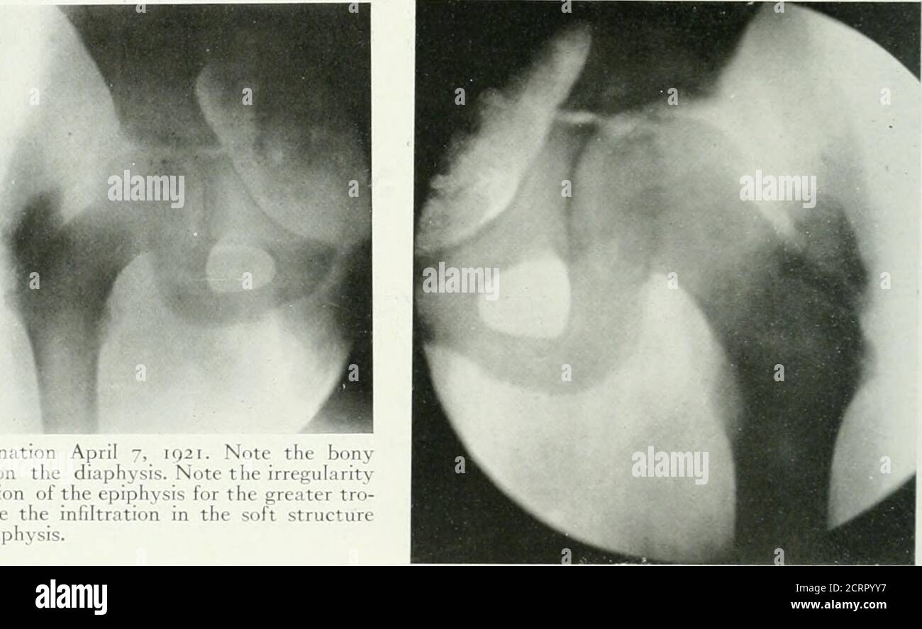 Intussusception Claw Sign