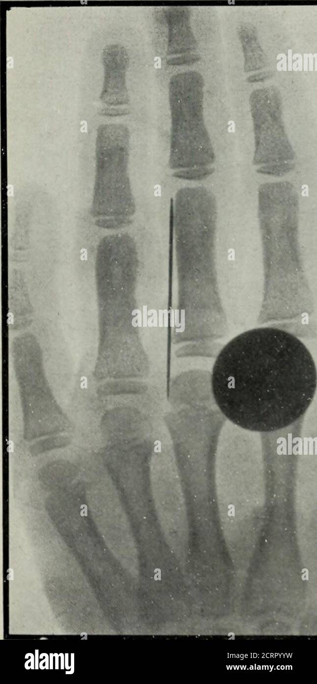 . Elementary and dental radiography . Fig. 339. Showing the coin on one ...