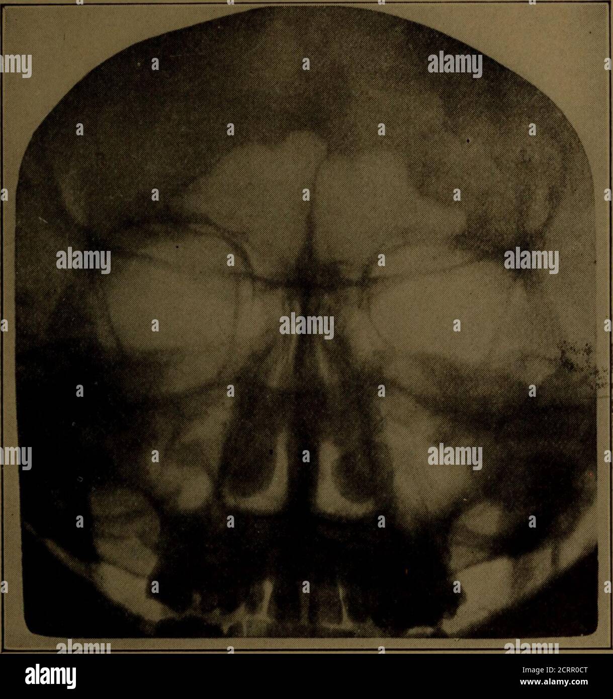 Normal x ray of sinuses hi-res stock photography and images - Alamy