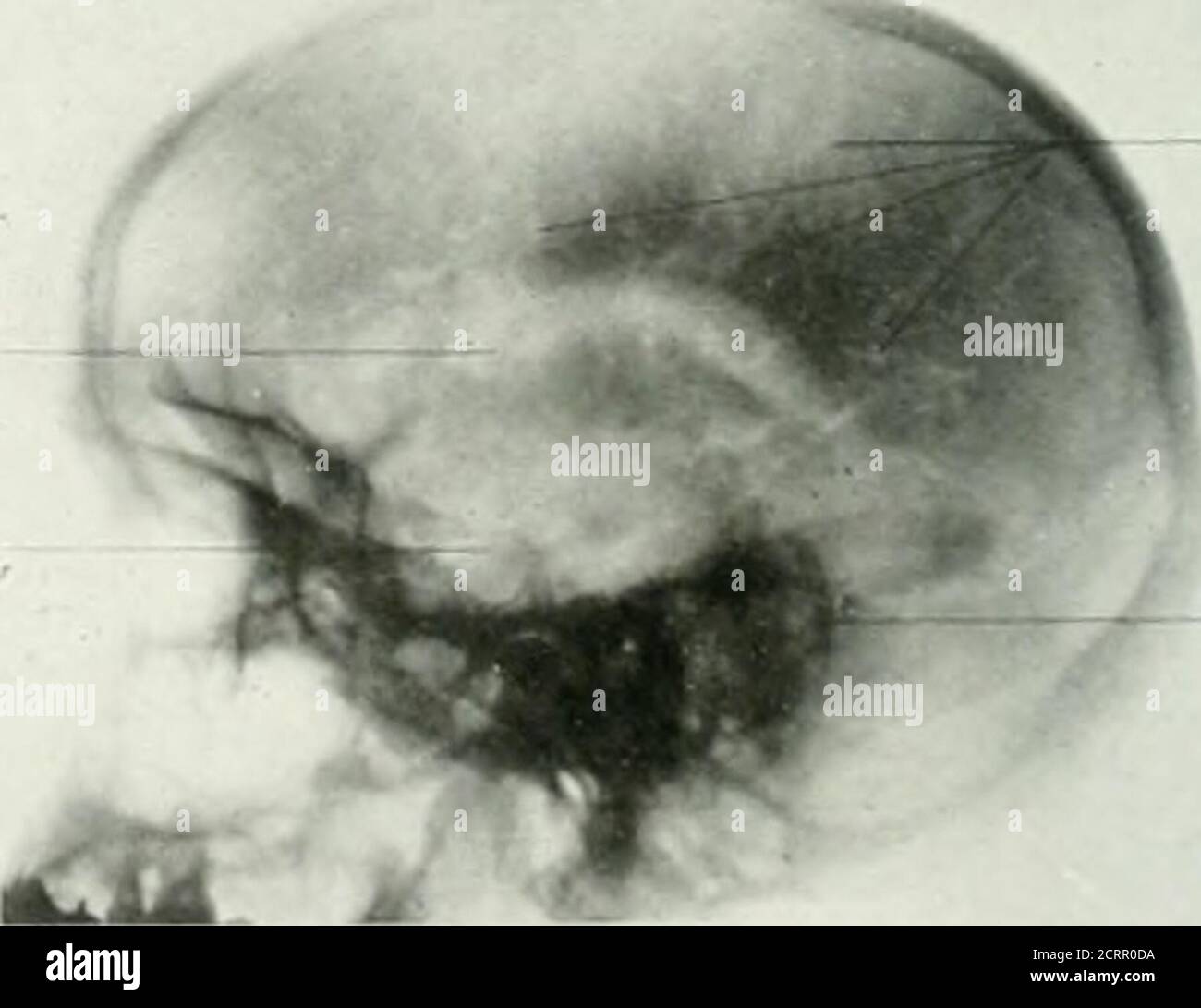 . The American journal of roentgenology, radium therapy and nuclear ...