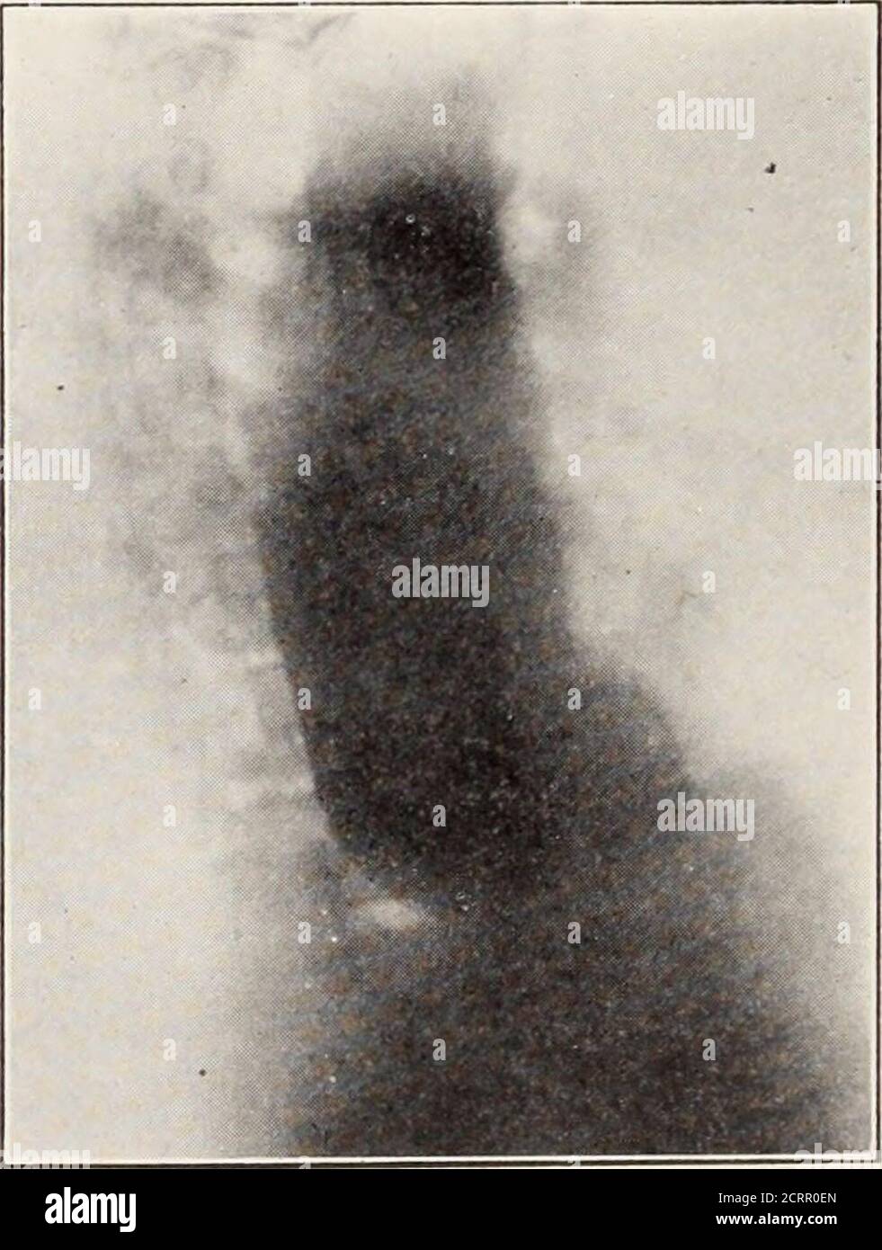 . Journal of roentgenology . FIG. V Advanced cardiospasm with ...