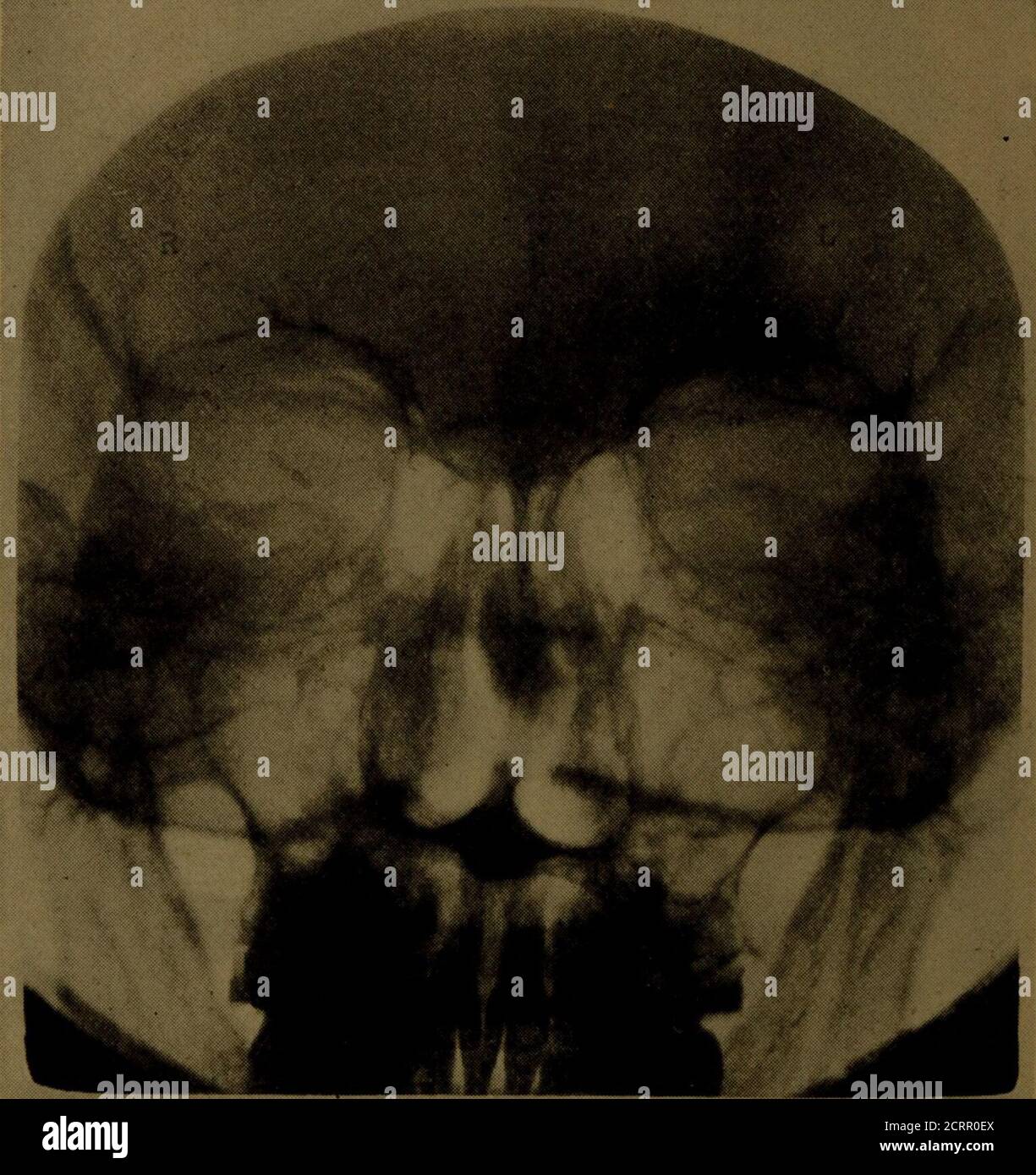 . X-ray manual : U.S. Army . Fig. 12. Normal and symmetrical accessory ...