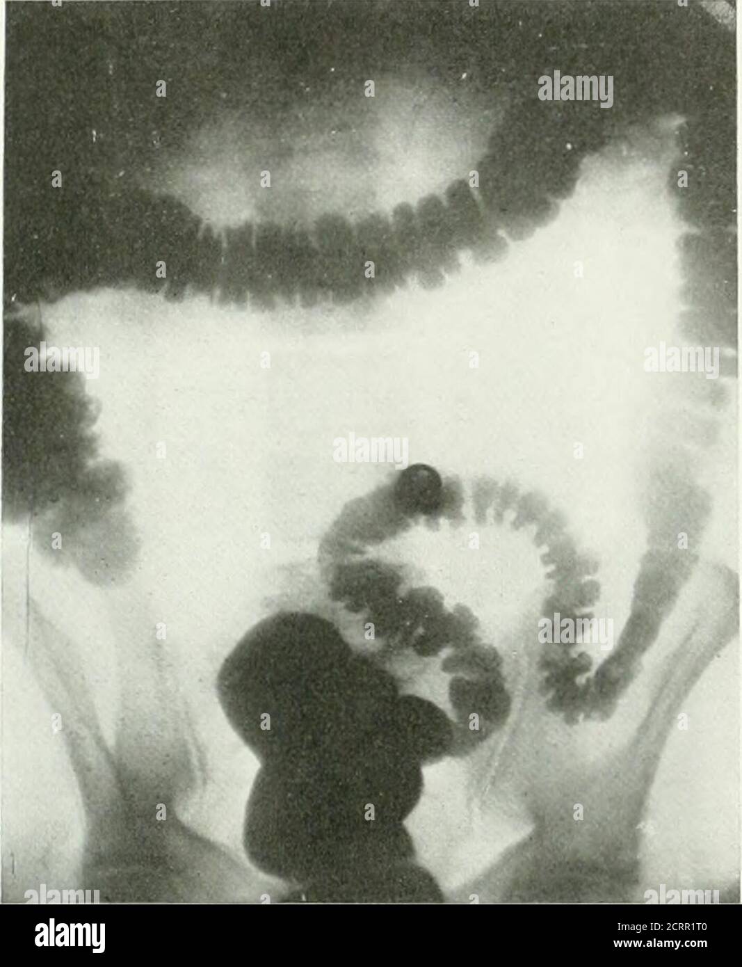 Recto sigmoid hi-res stock photography and images - Alamy