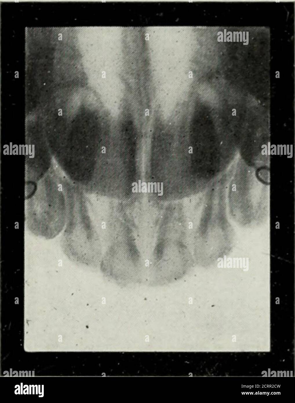 . Elementary and dental radiography . ent thatthe temporary tooth roots ...