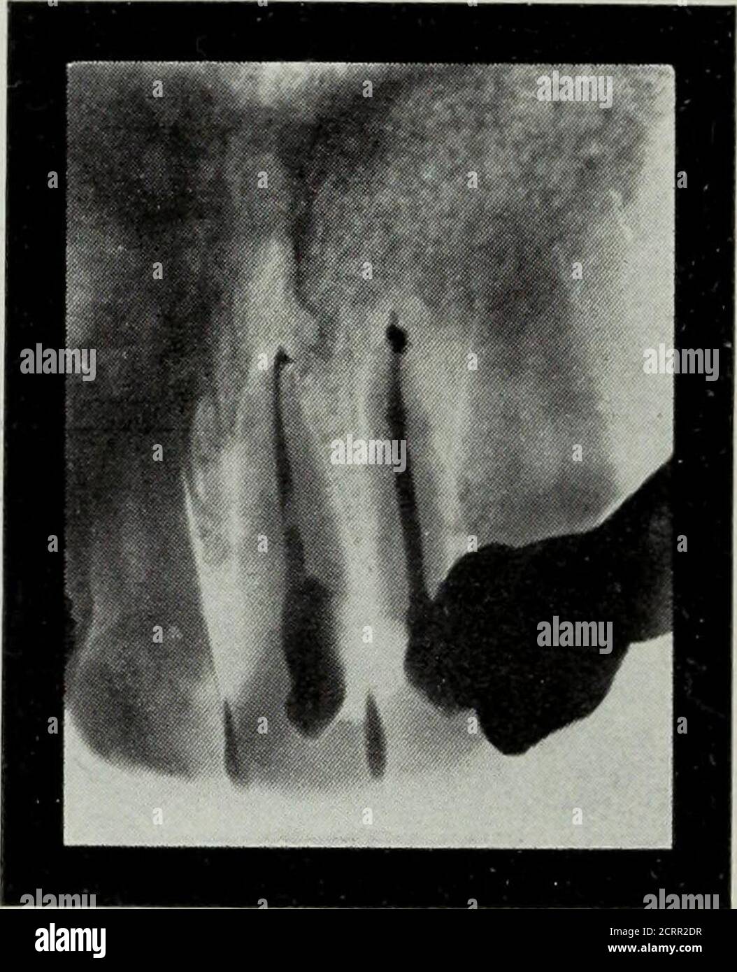 . Elementary and dental radiography . Fig. 300. Fig. 301. Fig. 300 ...